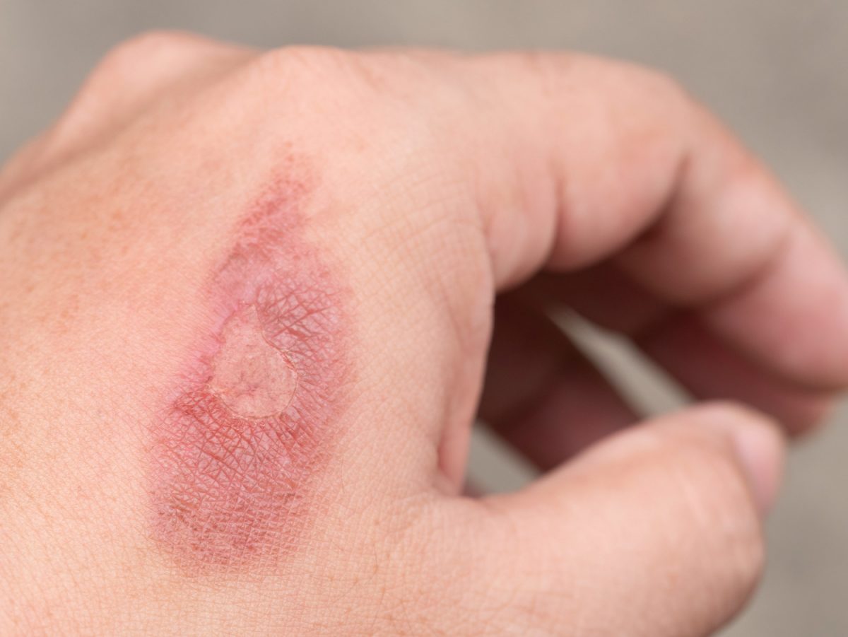 Treating Burn Injuries The RIGHT WAY – DOC2HOME